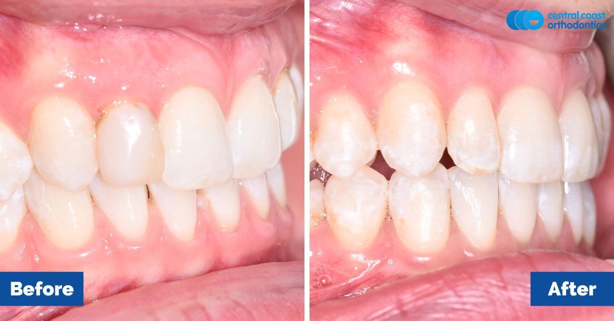 Patient of Wyee’s Invisalign Makeover - Central Coast Orthodontics