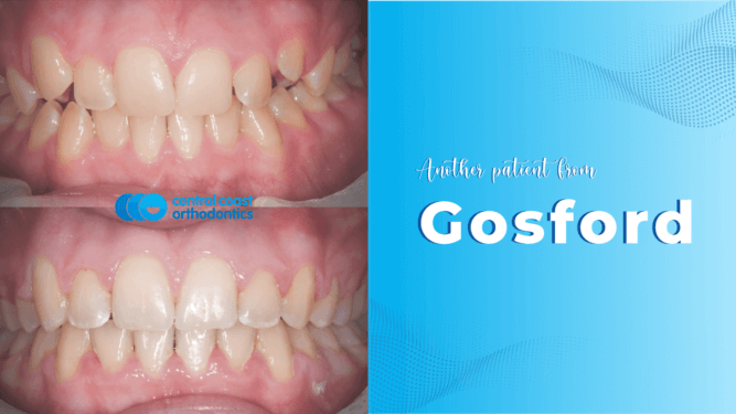 Ectopic Canine Treatment | Central Coast Orthodontics
