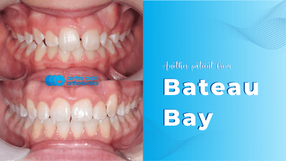 Impacted Canine Treatment | Central Coast Orthodontics