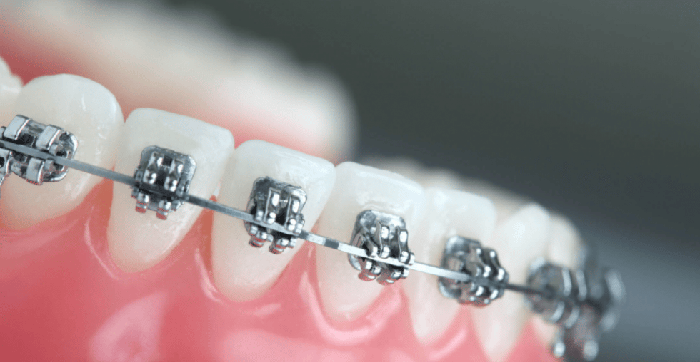 How Are Metal and Ceramic Braces Different? - Central Coast Orthodontics