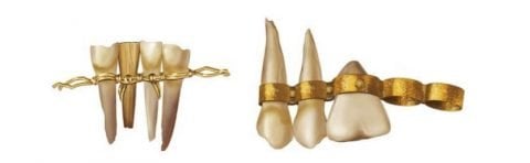 The History of Orthodontics: From Ancient Braces to Invisalign ...