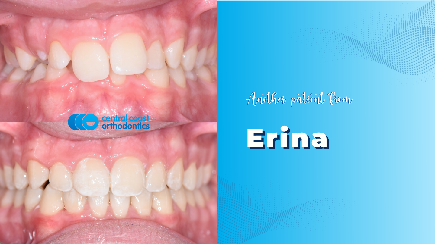 Patient of Erina’s Invisalign Makeover - Central Coast Orthodontics