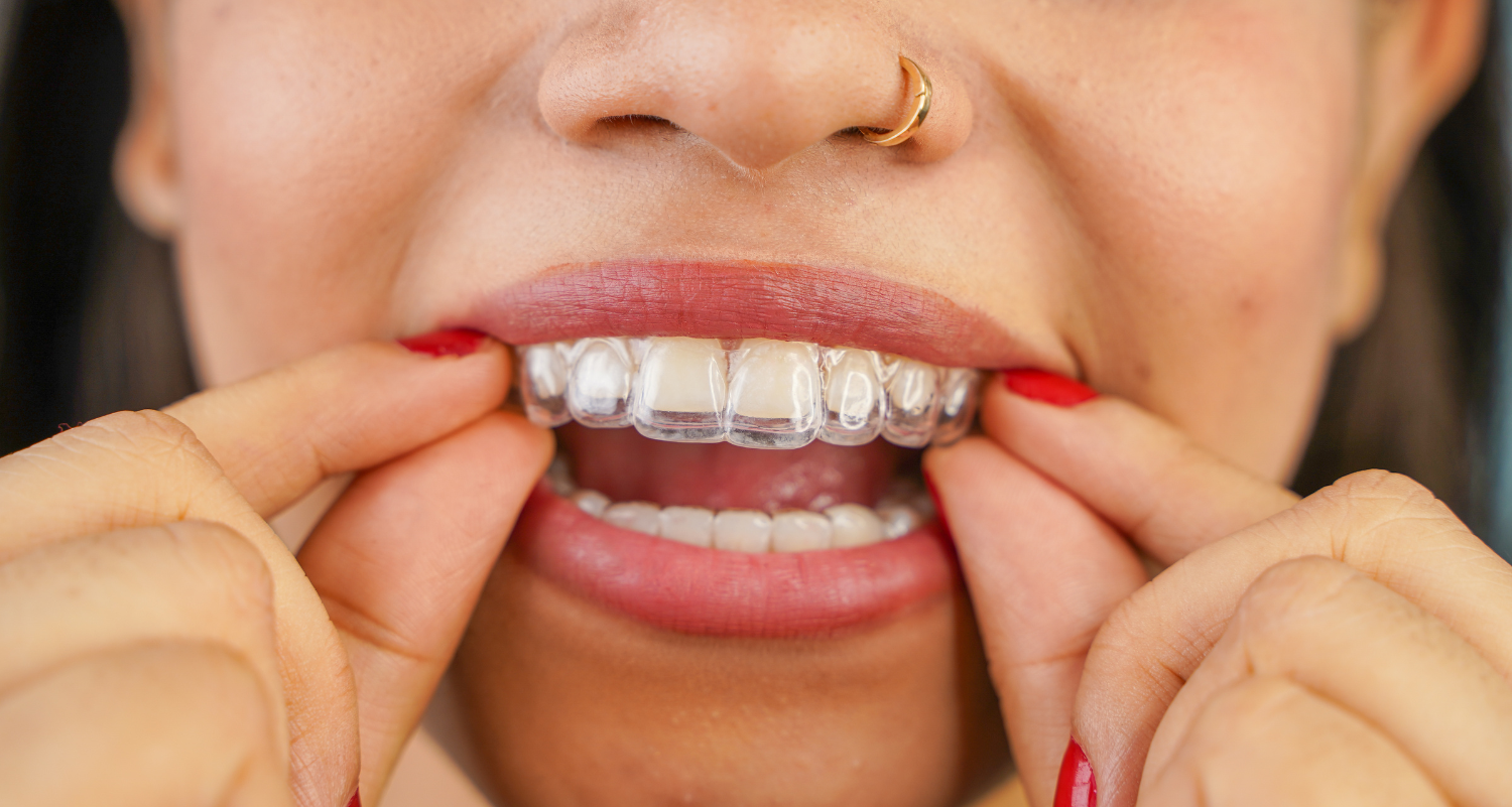 The History of Orthodontics: From Ancient Braces to Invisalign ...